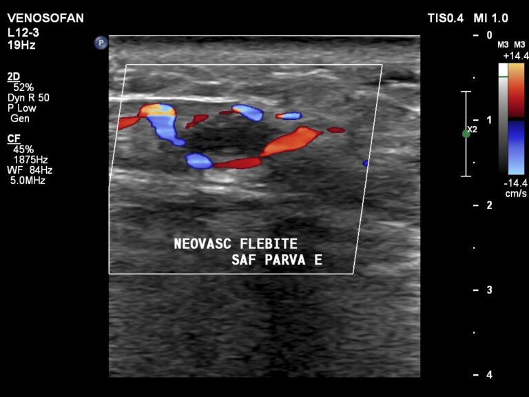 Identificação pelo eco-Doppler colorido de fístula arteriovenosa na ...